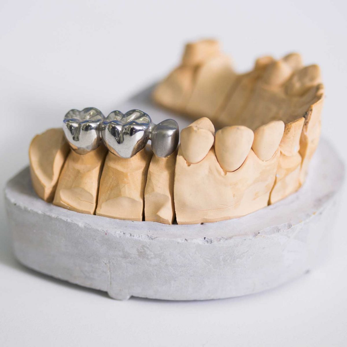 Porcelain Fused Metal - Sinterex