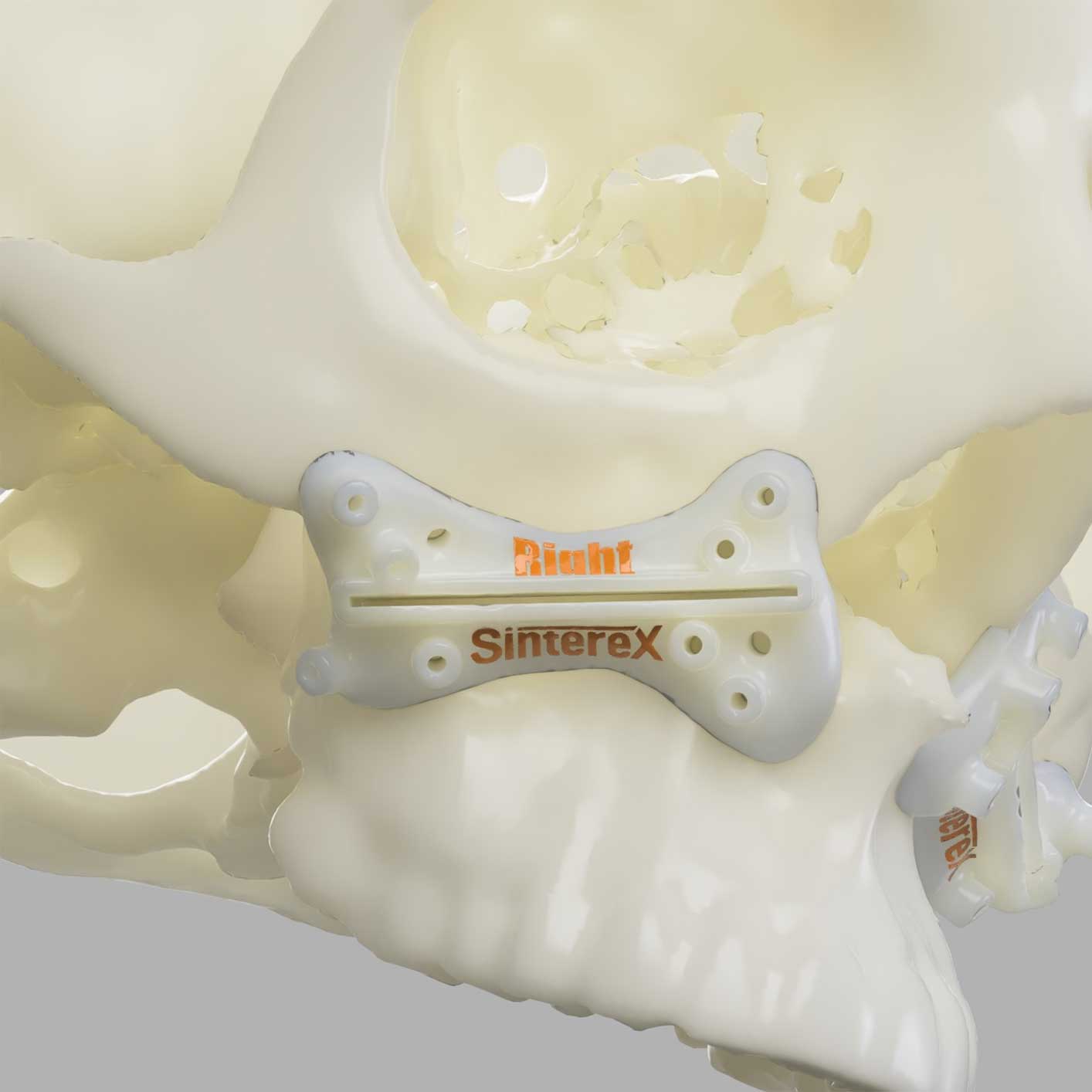 Surgical Guides - Sinterex