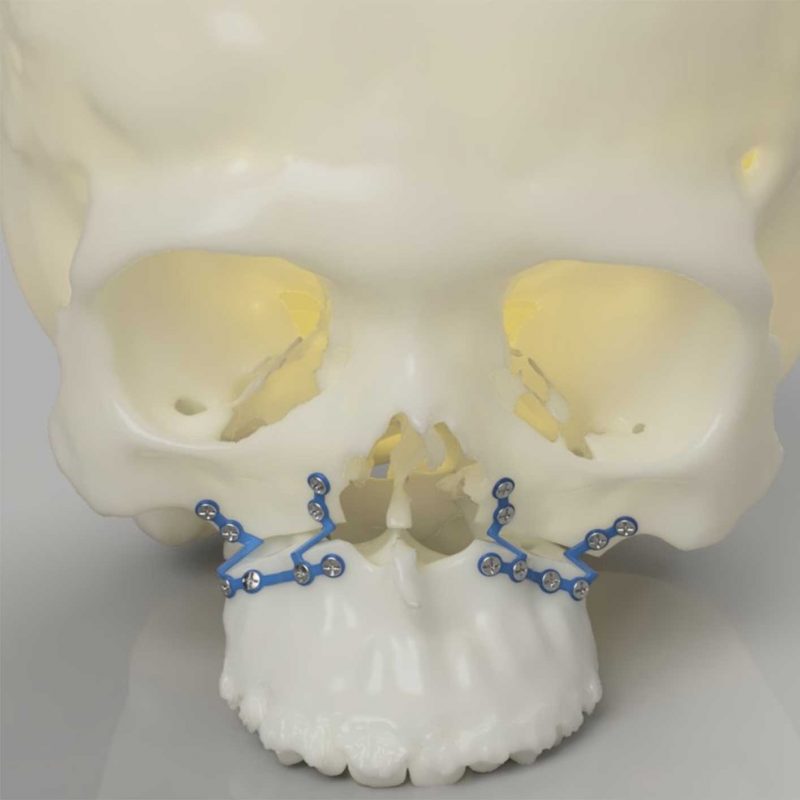 Patient Specific Implants - Sinterex