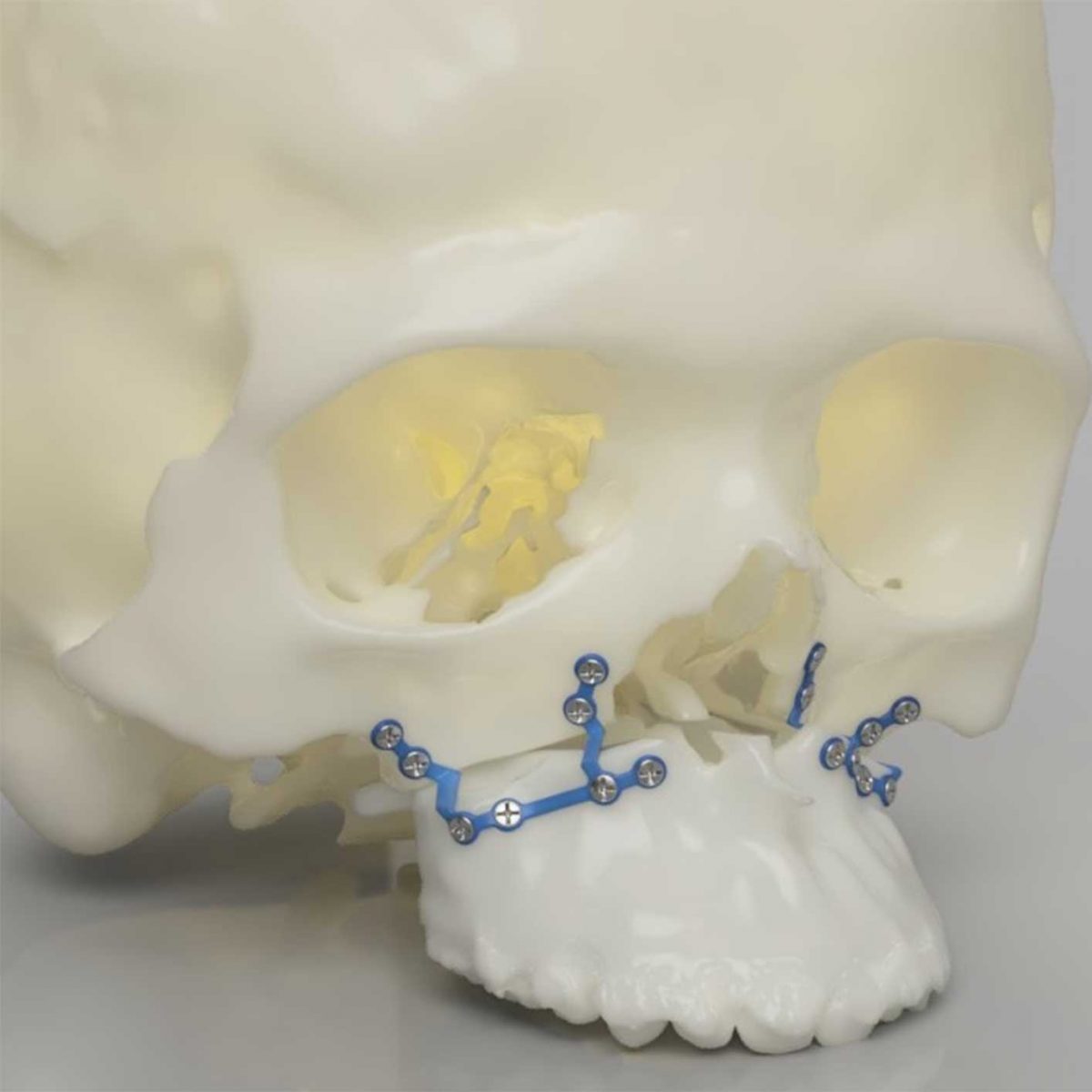 Patient Specific Implants - Sinterex